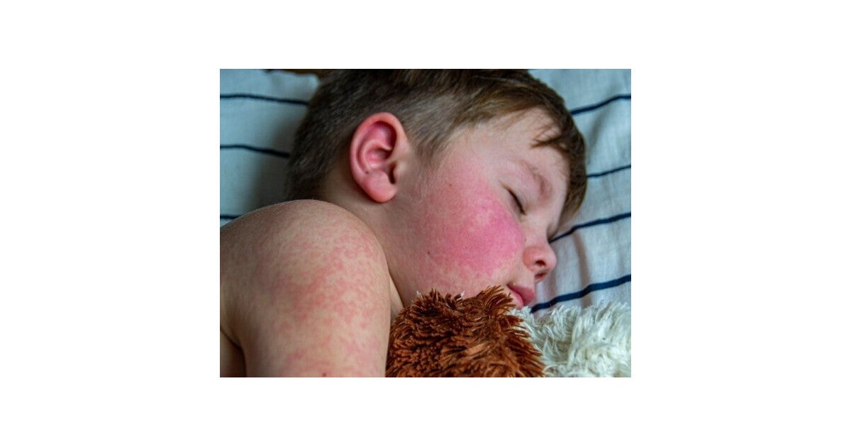 Eritema infeccioso e os cuidados com a criança | Nestlé FamilyNes